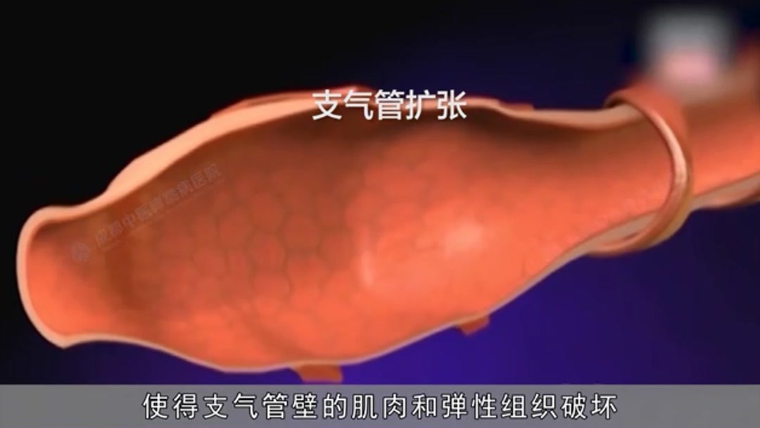 支气管扩张是什么原因