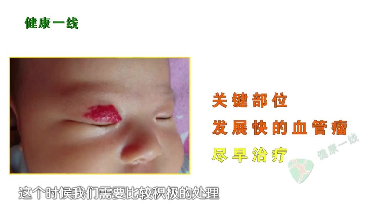 血管瘤很多都不影响健康,但长在这几个部位除外,你家宝宝是吗?
