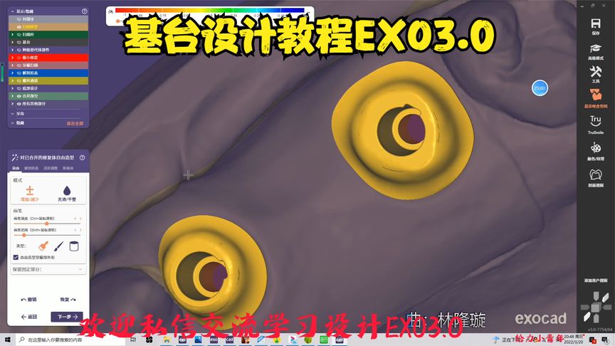 三连桥种植基台设计(详细教程EXO3.0)