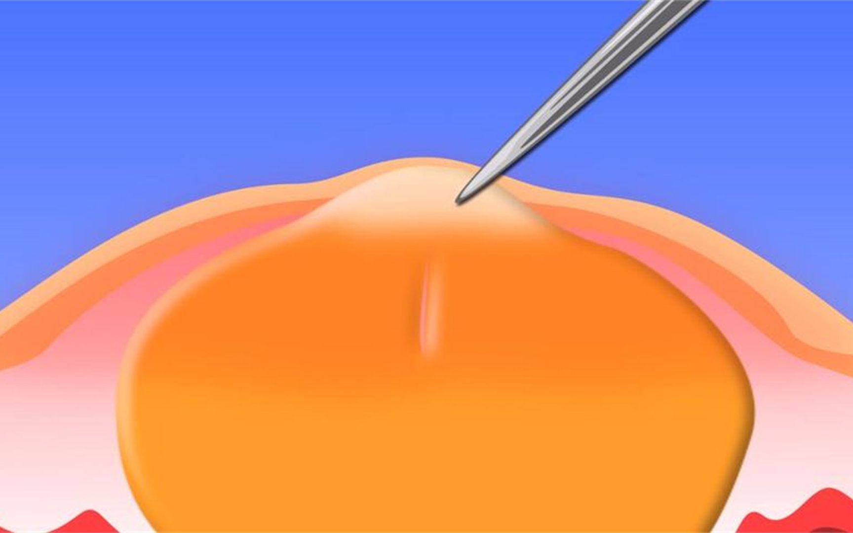 痘痘里到底装的什么玩意?动画还原痘痘形成过程,涨知识了!