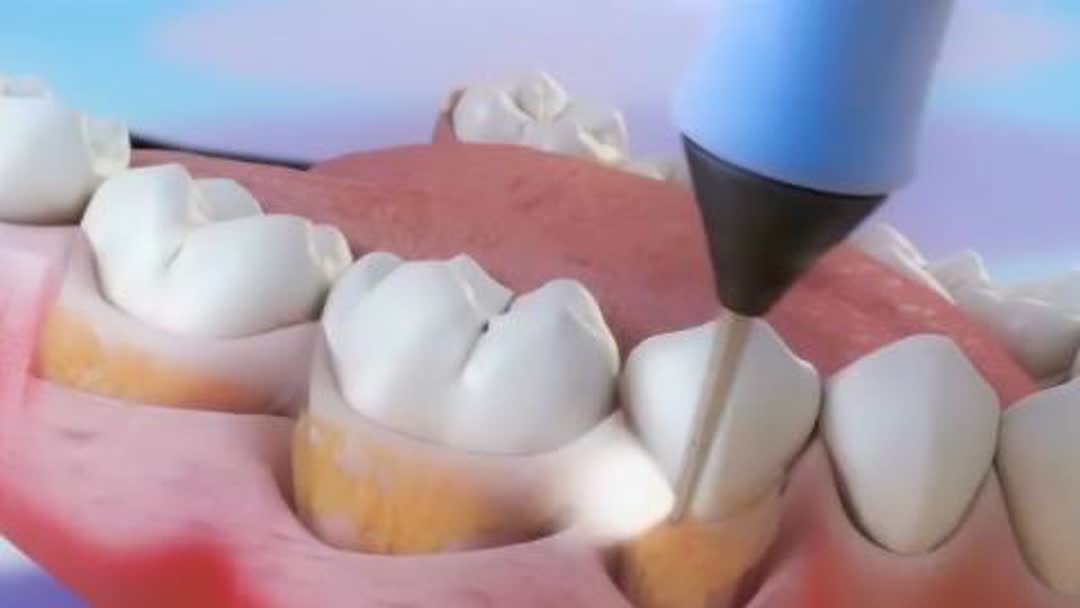 蛀牙的最新治疗方法,照照激光就能治好,牙齿再生将要梦想成真!