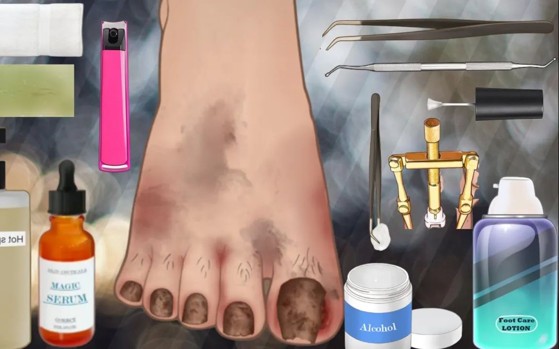 【沉浸式修脚】美甲沙龙动画!去除内生脚趾甲!