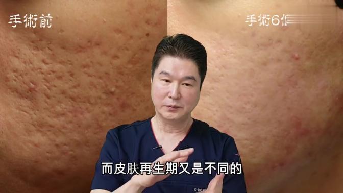 去痘疤去痘坑机械削皮术恢复过程