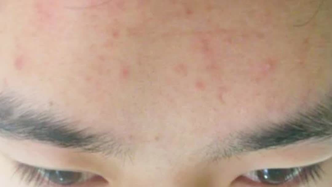 痤疮都有哪些常见类型?爱长痤疮和体质有没有关系?