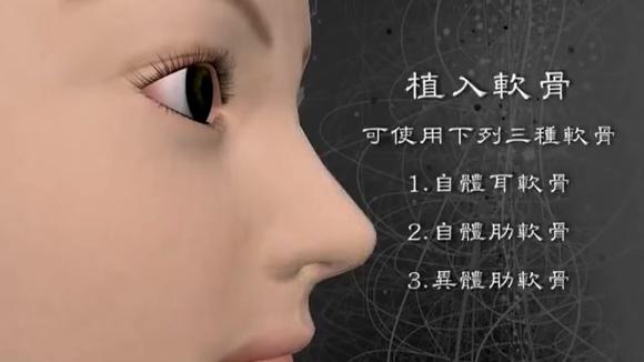 整容原理解密!视频讲解,用3D演示隆鼻、三段式隆鼻手术全过程