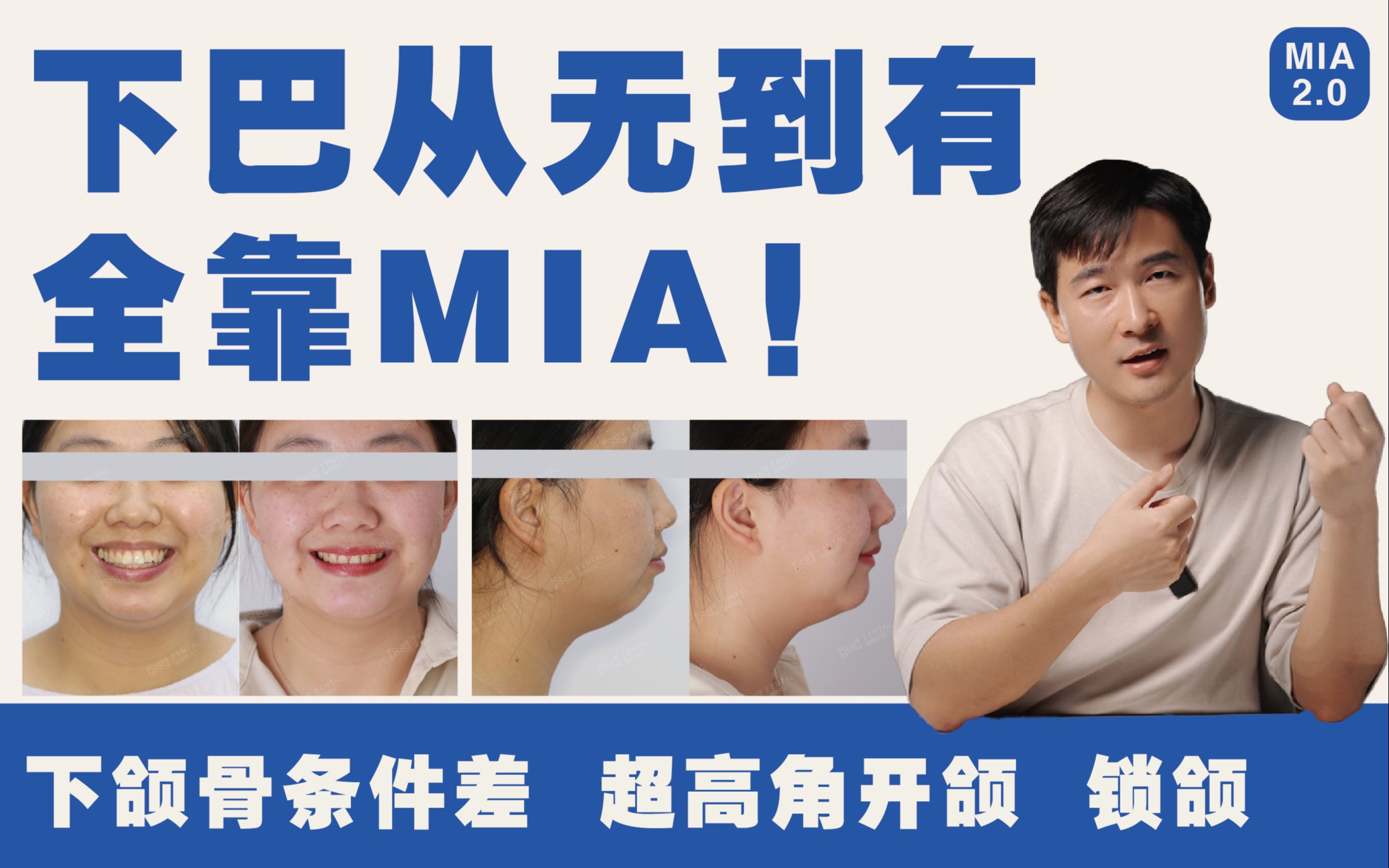 MIA2.0,合平面顺时针旋转,下颌平面逆时针旋转