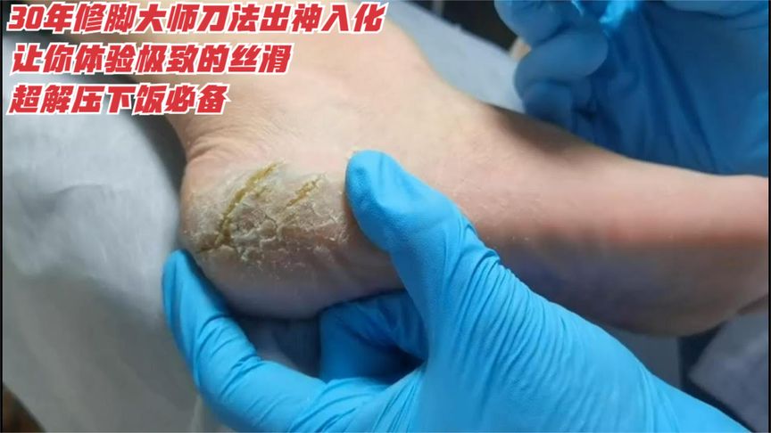 30年修脚大师刀法出神入化,让你体验极致的丝滑,超解压下饭必备