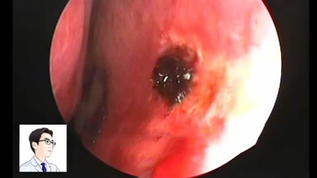 电凝处理鼻出血