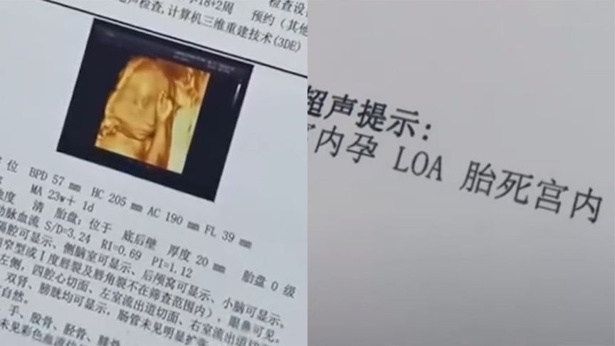 丈夫与保安起冲突,孕妇劝架被撞胳膊致胎死腹中:已怀胎7个月