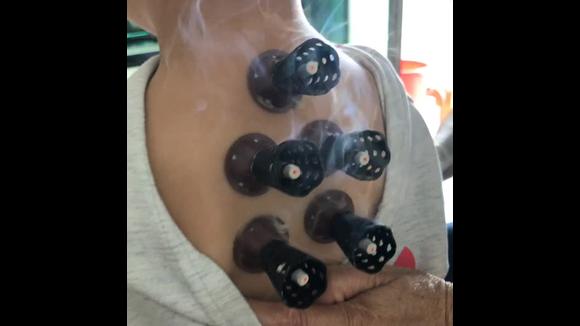一边看着动画片,一边艾灸调理咳嗽,小宝乖得不行