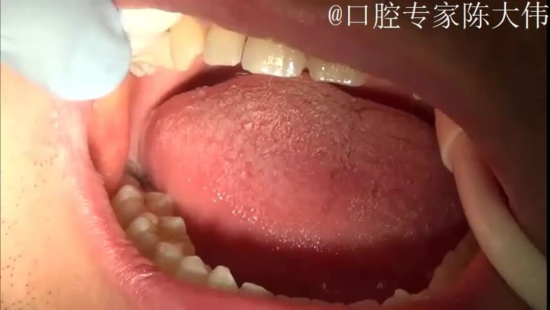 【口腔专家陈大伟】根管治疗全过程