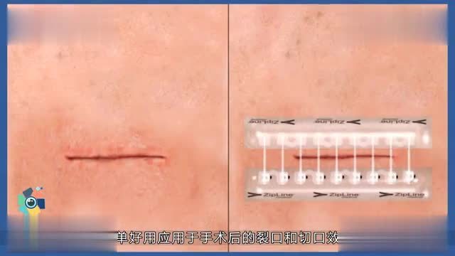 以色列军医发明皮肤缝合器,伤口一拉就能愈合...