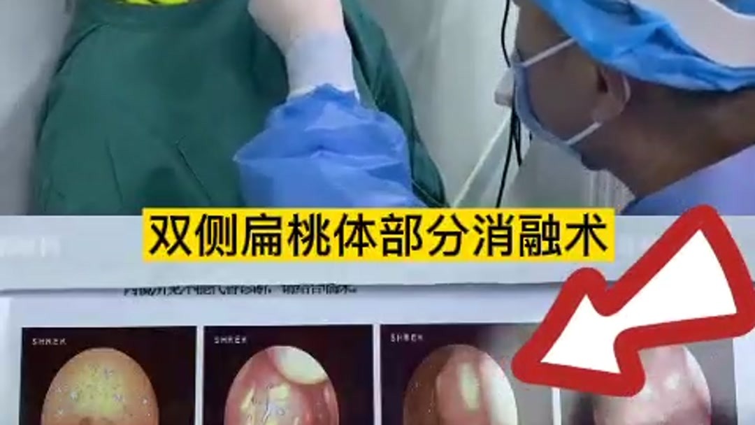 低温鼻内镜等离子双侧扁桃体消融术术,微创最新前沿技术