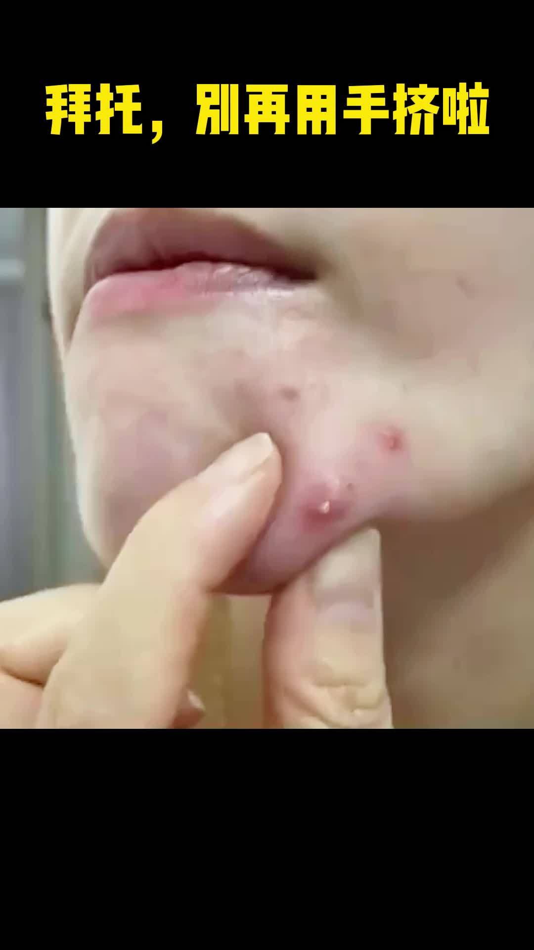 拜托,别再用手挤啦,越挤毛,孔越大!#壬二酸#水杨酸#拒绝草莓鼻(`･ω...