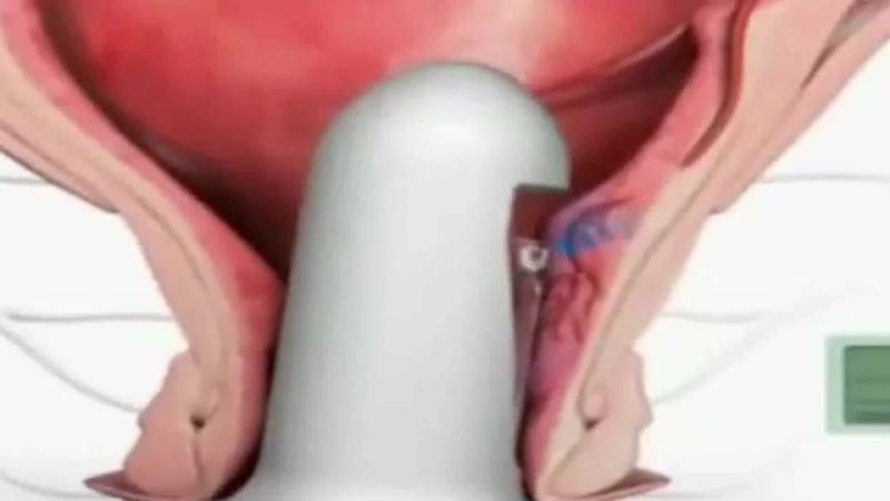 原来痔疮是这样做手术的,不得不说科技发展的真快