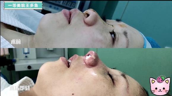 实拍鼻综合隆鼻全过程,35岁的我想要在变美,术后老公看了都说值