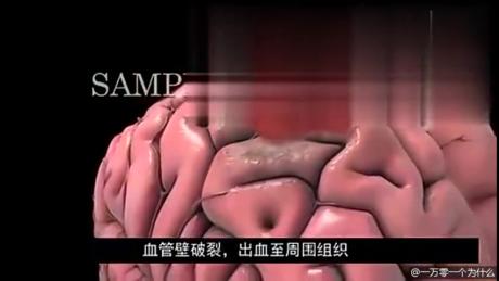 医学视频,4分钟让您重新认识高血压