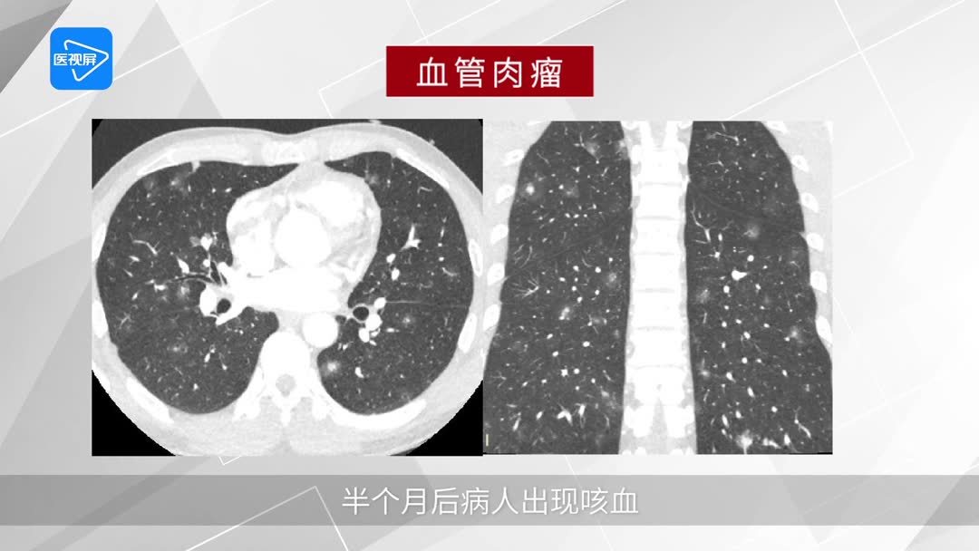 最常见的心脏恶性肿瘤--血管肉瘤的临床诊断特征