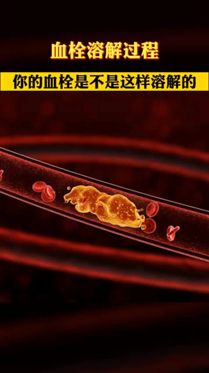 你的血栓是不是也是这样溶解的心血管心脑血管疾病预防