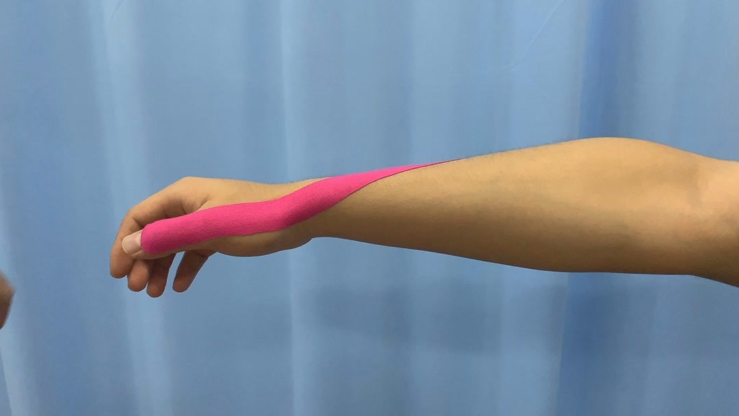 桡骨茎突狭窄性腱鞘炎空间提拉贴扎