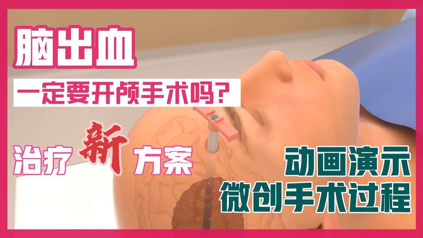 脑出血怎么办 不用开颅的手术 动画演示颅内出血的微创手术全过程