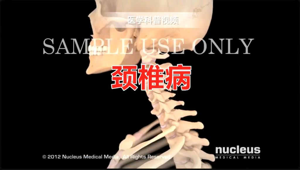 【医学科普视频】:颈椎病是怎么回事
