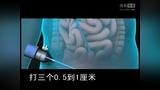 输卵管不孕