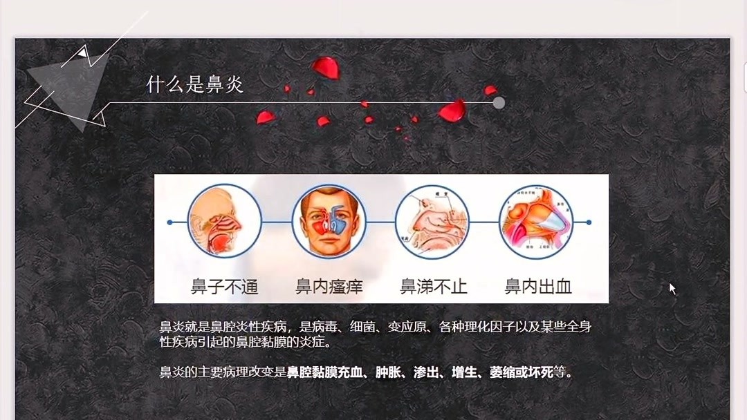 鼻炎吃什么药好,鼻炎手术视频,鼻炎手术过程,鼻炎是什么症状