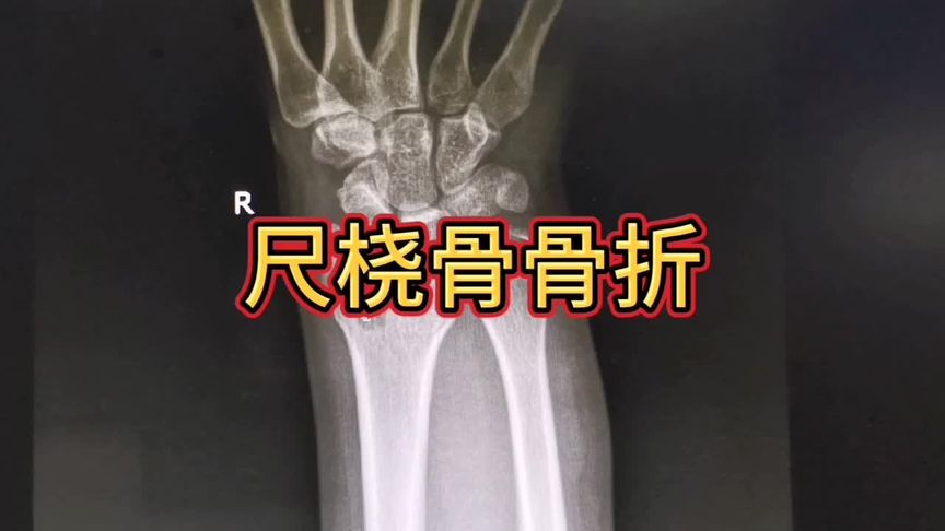尺桡骨远端骨折x线病例分享#骨折