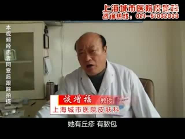 痘疗法 上海城市医院皮肤科
