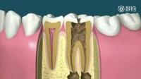 看着都疼的牙齿根管治疗术
