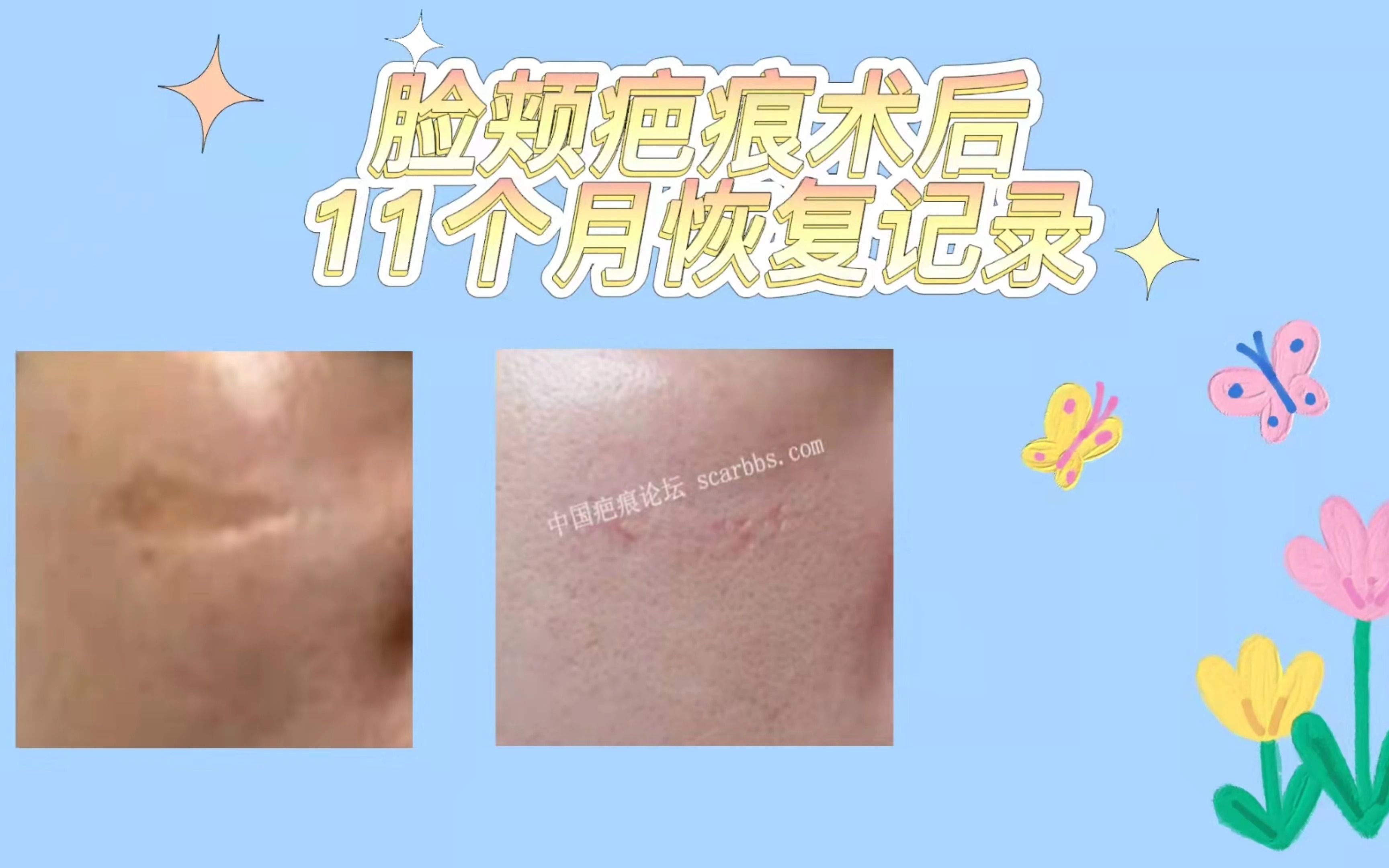 【阿国战疤第25期】美女脸颊深凹陷疤痕修复得如何?