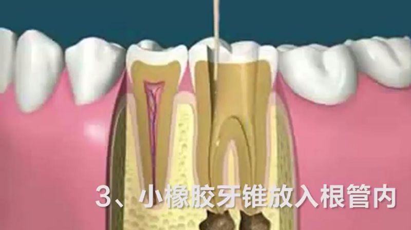 看着都疼的牙齿根管治疗术!看完这个视频 马上去刷牙了