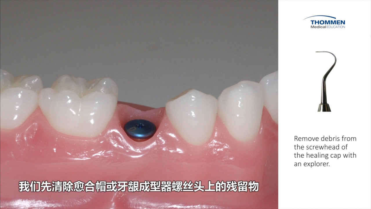 种植体水平开窗取模