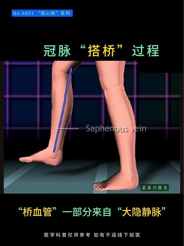 冠脉"搭桥"过程 冠心病的"桥"是怎么"搭"的? "桥"是怎么做的? "桥"怎么...