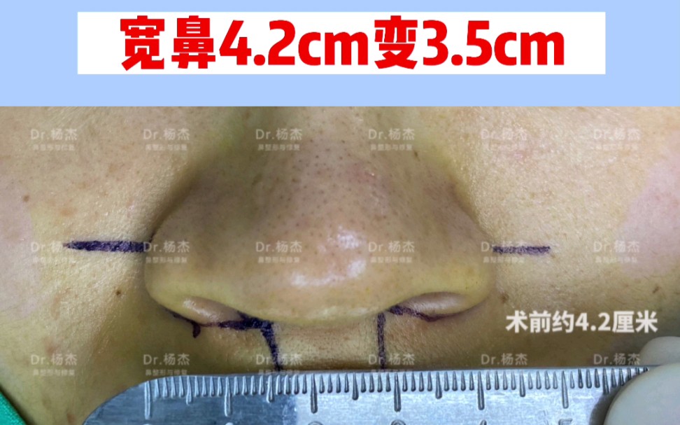 大鼻翼缩小鼻孔缩小4.2cm鼻翼缩小至3.5cm