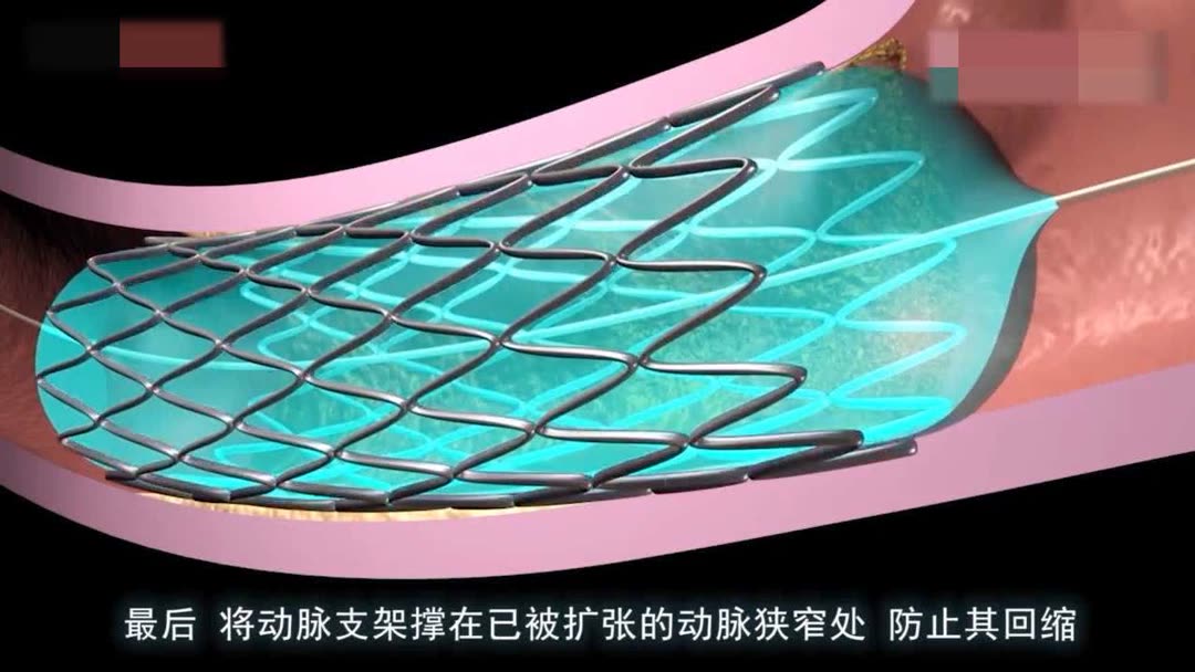 3D动画演示心脏支架是怎样放进去的?这下明白了