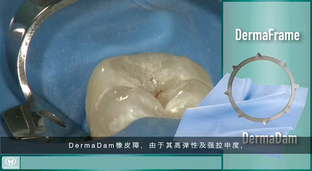 微创根管治疗操作