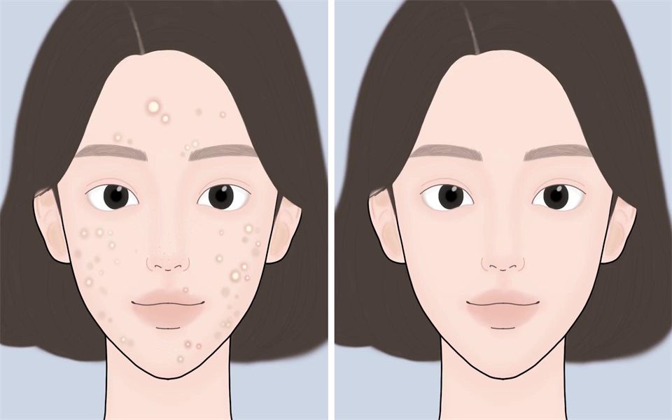 去除粉刺、黑头和痘痘动画
