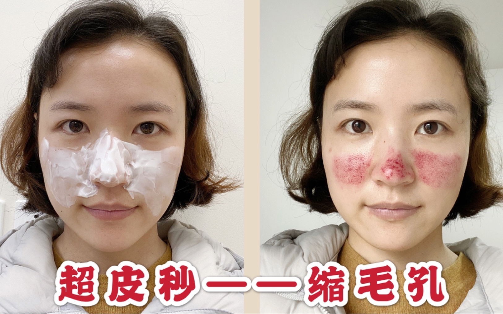 【Lily】超皮秒缩毛孔——术后记录~day1,做完脸颊部分破皮,很红~比...