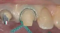 (最新高清国外视频)牙体预备、印模制取--亚太口腔医学网_标清