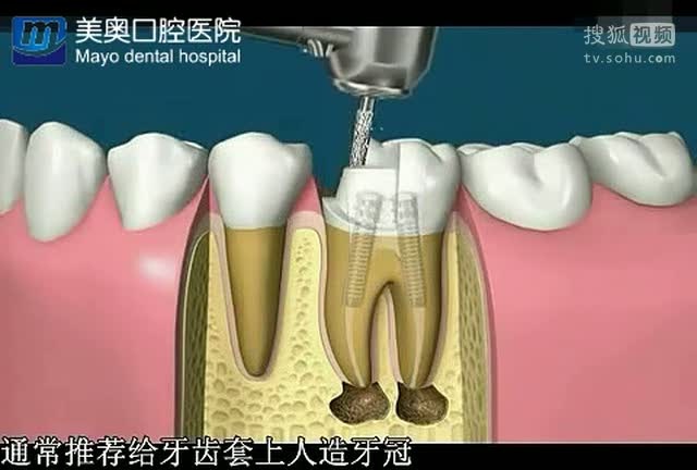 根管治疗过程(动画演示)