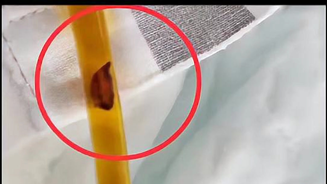 广西:医生为男子用导管排虫,他每天看着肝吸虫不断从体内爬出