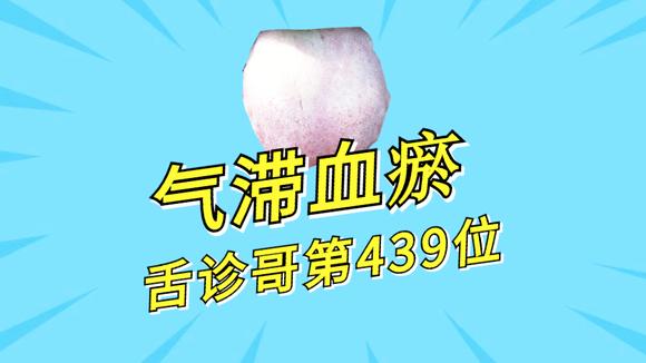 舌诊哥:舌诊系列第439位,气滞血瘀,慢性病久治不愈的原因之一