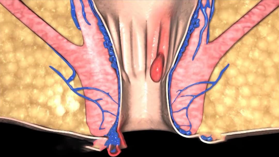 科普痔疮的临床表现及特点,概述常见的手术方式