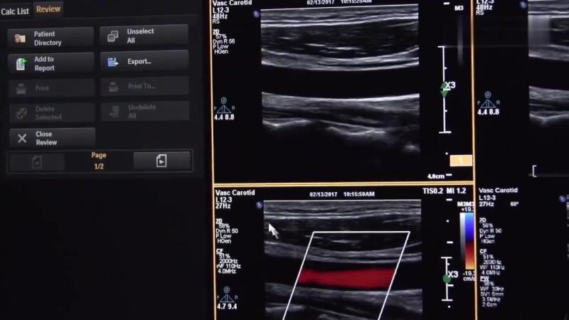 超声技术-科研定量-QVue软件-软件简介及获取途径