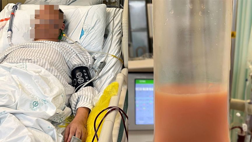男子饮下冰镇饮料后送进ICU 医生在其血液中透析出一大袋油脂