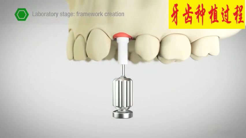 3D动画演示牙齿种植过程