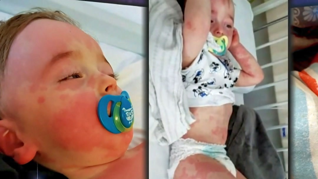 美国纽约州又有百名儿童感染不明疾病 且新冠病毒检测均呈阳性