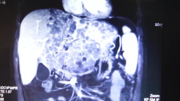 肝癌持续性肝动脉灌注化疗术,挽救晚期肝癌患者